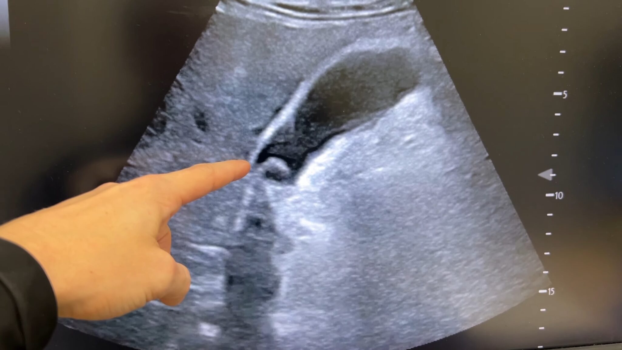 Contracted Gallbladder-Diagnosis and Treatment! - Iaas Med