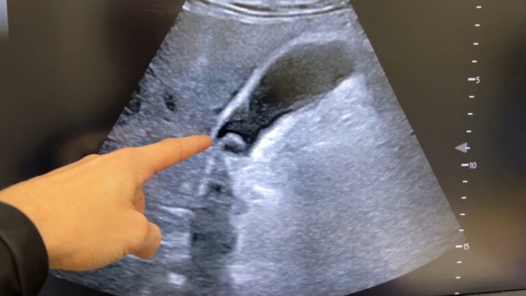 Contracted Gallbladder-Diagnosis and Treatment! - Iaas Med