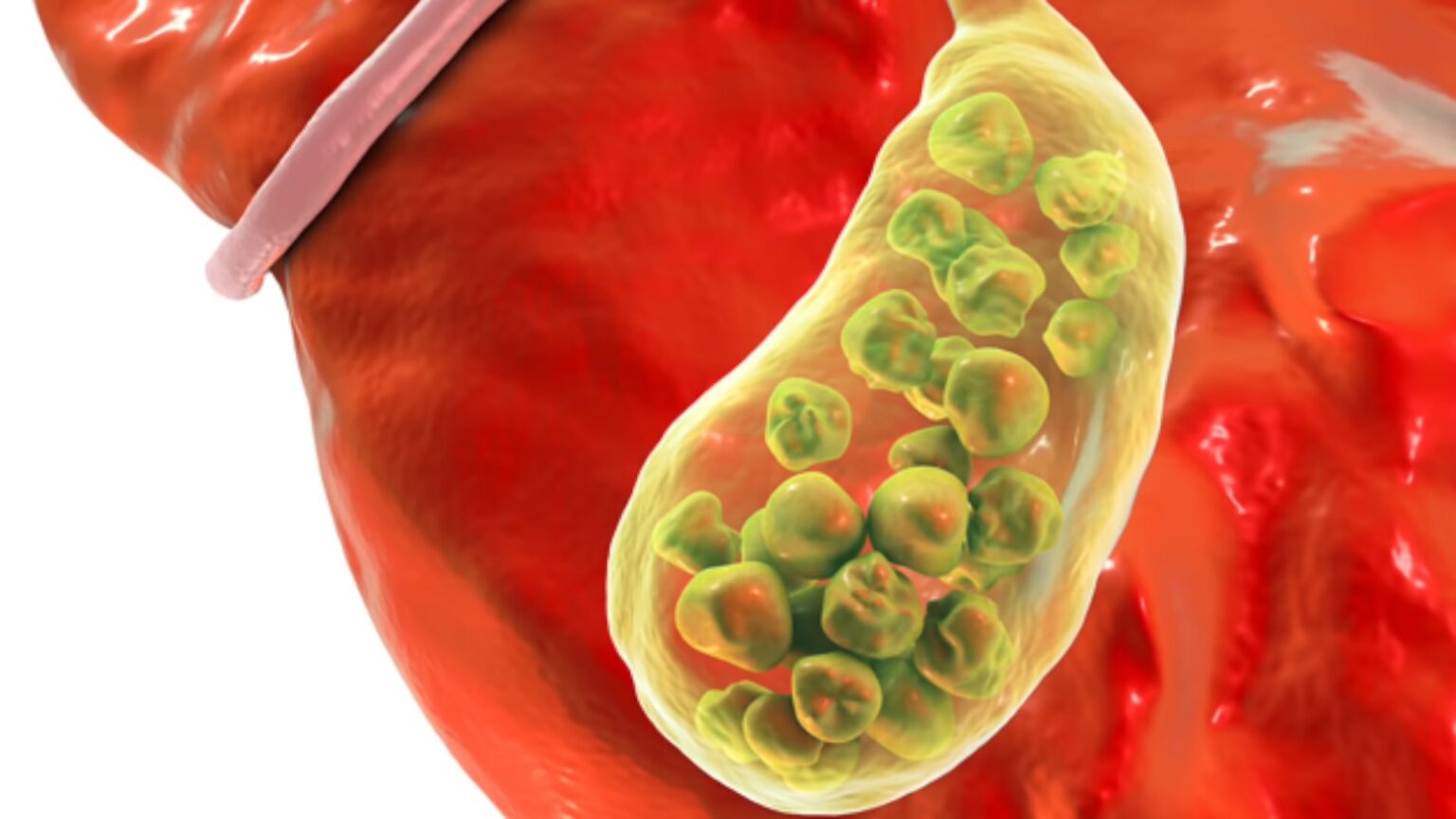 What Is Calculus of Gallbladder with Acute Cholecystitis? - Exploring ...