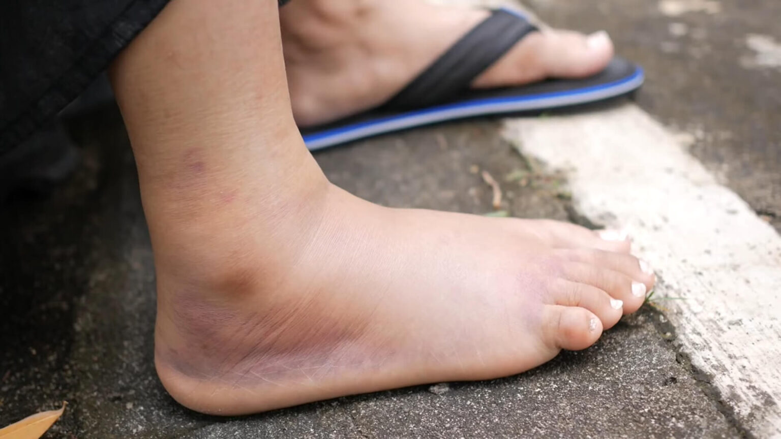 How to Treat a Blood Clot in Your Leg - DVT Treatment Options - Iaas Med