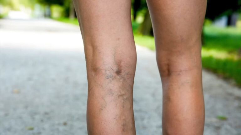 How to Treat a Blood Clot in Your Leg - DVT Treatment Options - Iaas Med