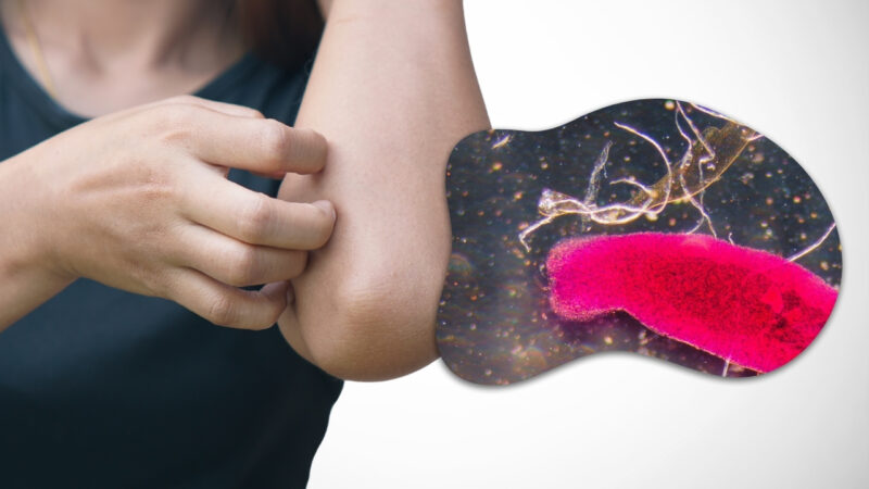 Signs of Parasitic Infections - 10 Key Symptoms Explained - Iaas Med